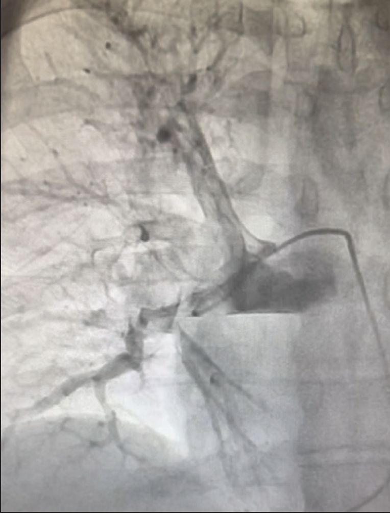 Penumbra’s Commitment to Venous Disease - Endovascular Today