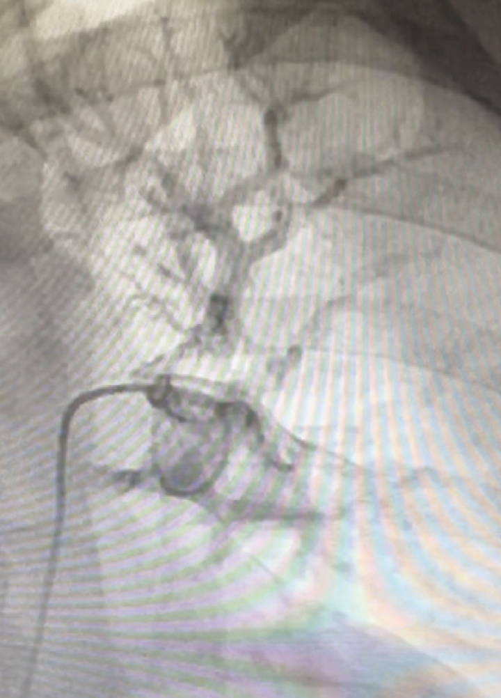 Penumbra’s Commitment to Venous Disease - Endovascular Today