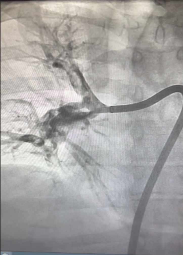 Penumbra’s Commitment to Venous Disease - Endovascular Today