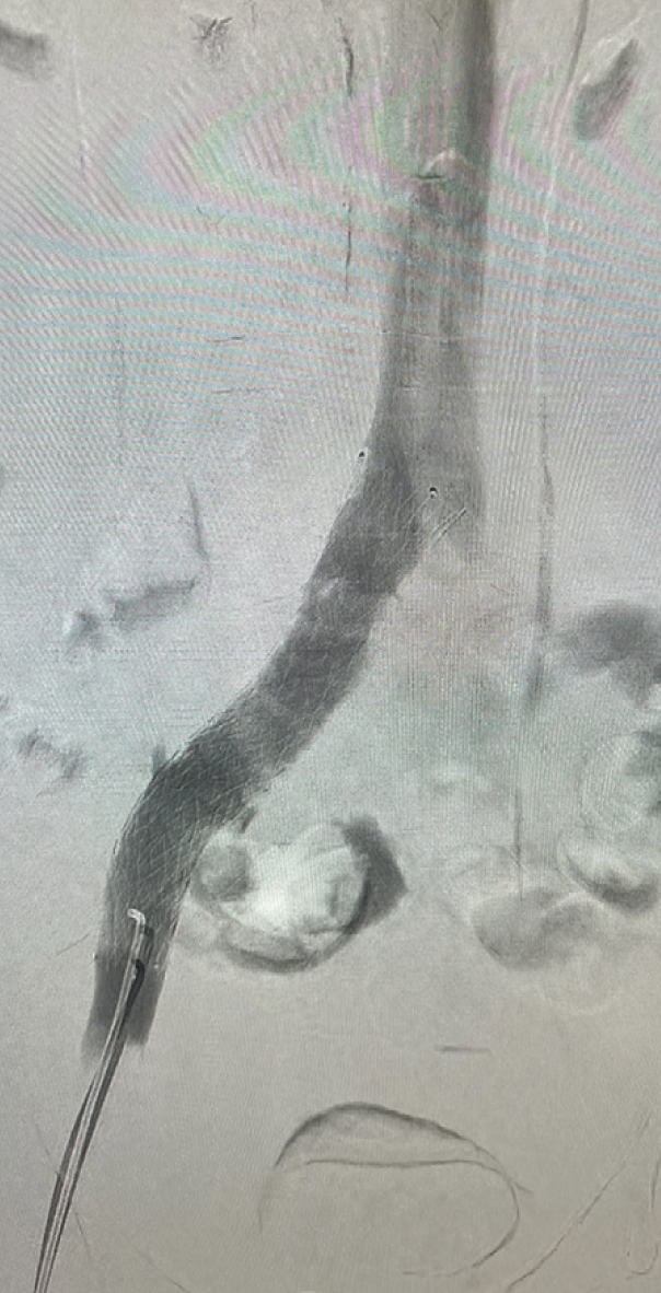 Penumbra’s Commitment to Venous Disease - Endovascular Today