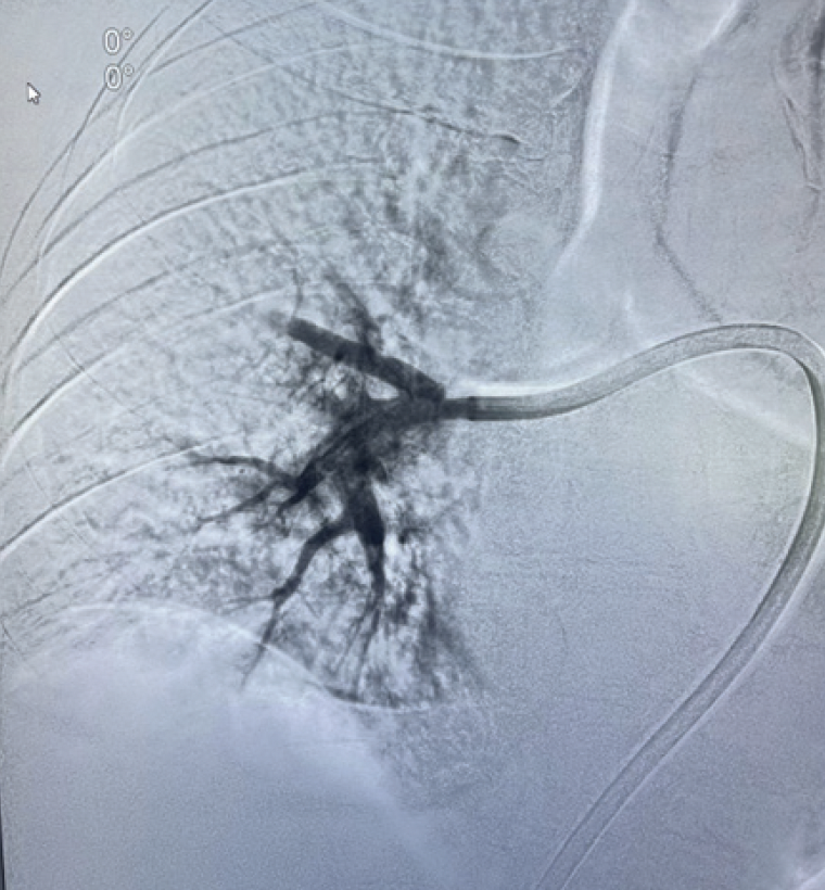 Penumbra’s Commitment to Venous Disease - Endovascular Today