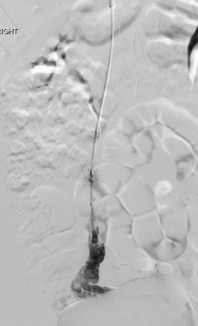 Penumbra’s Commitment to Venous Disease - Endovascular Today