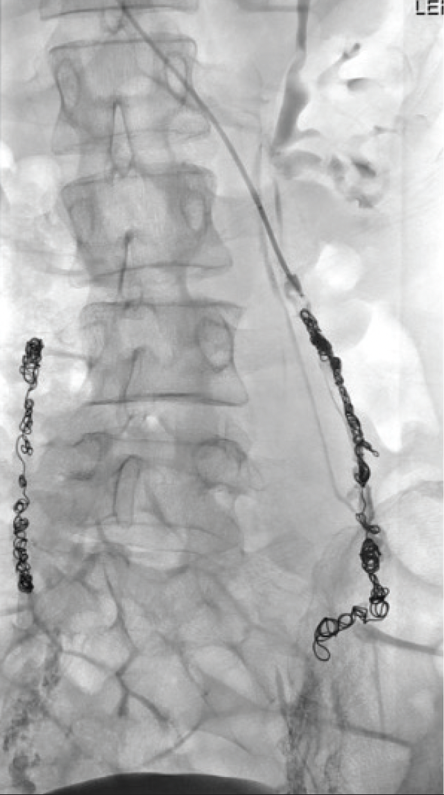 Penumbra’s Commitment to Venous Disease - Endovascular Today