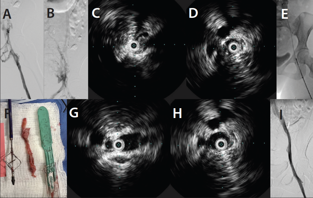 Breaking New Ground to Address Challenging Venous Occlusions ...