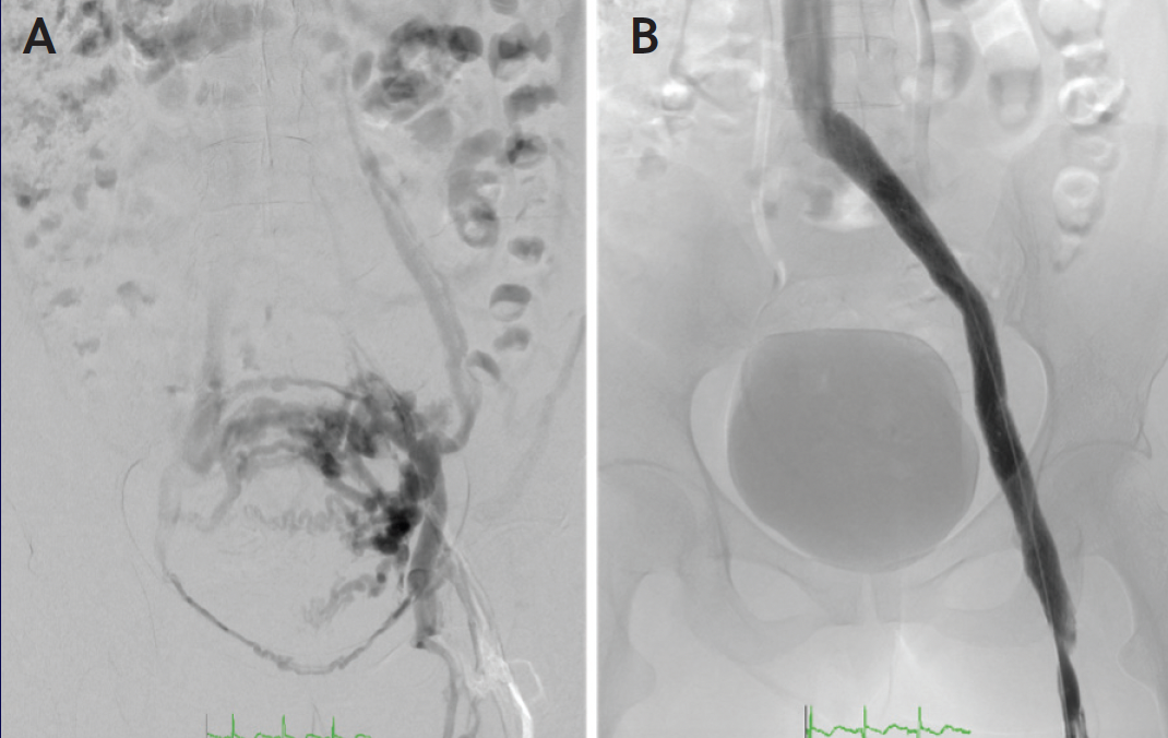 Nontraditional Venous Stent Patient Pathways - Endovascular Today