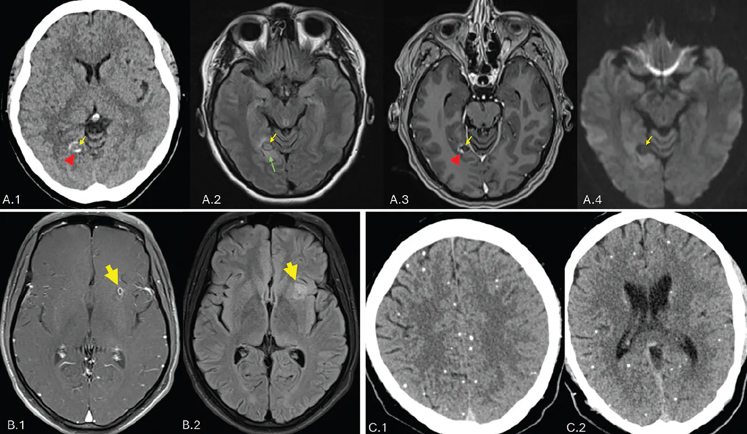 Neurosyphilis Spinal Cord Neurosyphilis Wikipedia