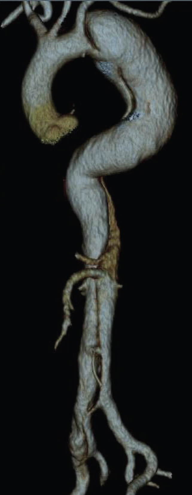 Spinal Drains: When, How, in and by Whom, and Optimal Follow-Up ...