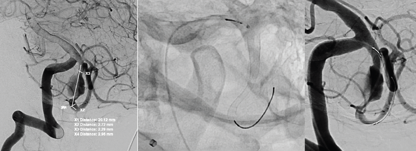 New Flow Diversion Technology: Tips and Pitfalls - Endovascular Today