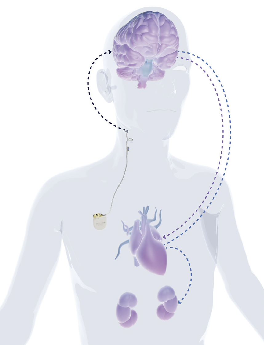 Physician Experience and Surgical Techniques With Baroreflex Activation ...