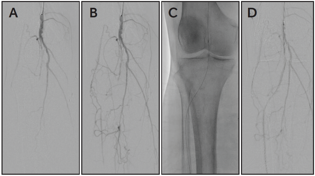 A New Age of Laser Atherectomy: Safe and Effective for Arterial Lesion ...