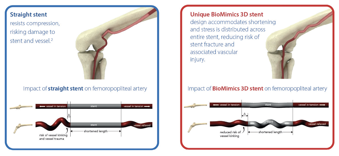 My Femoropopliteal Complex Lesion Treatment Algorithm - Endovascular Today