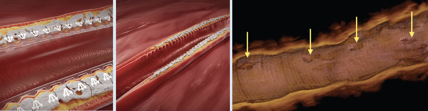 The Serranator® PTA Serration Balloon Catheter in Practice ...