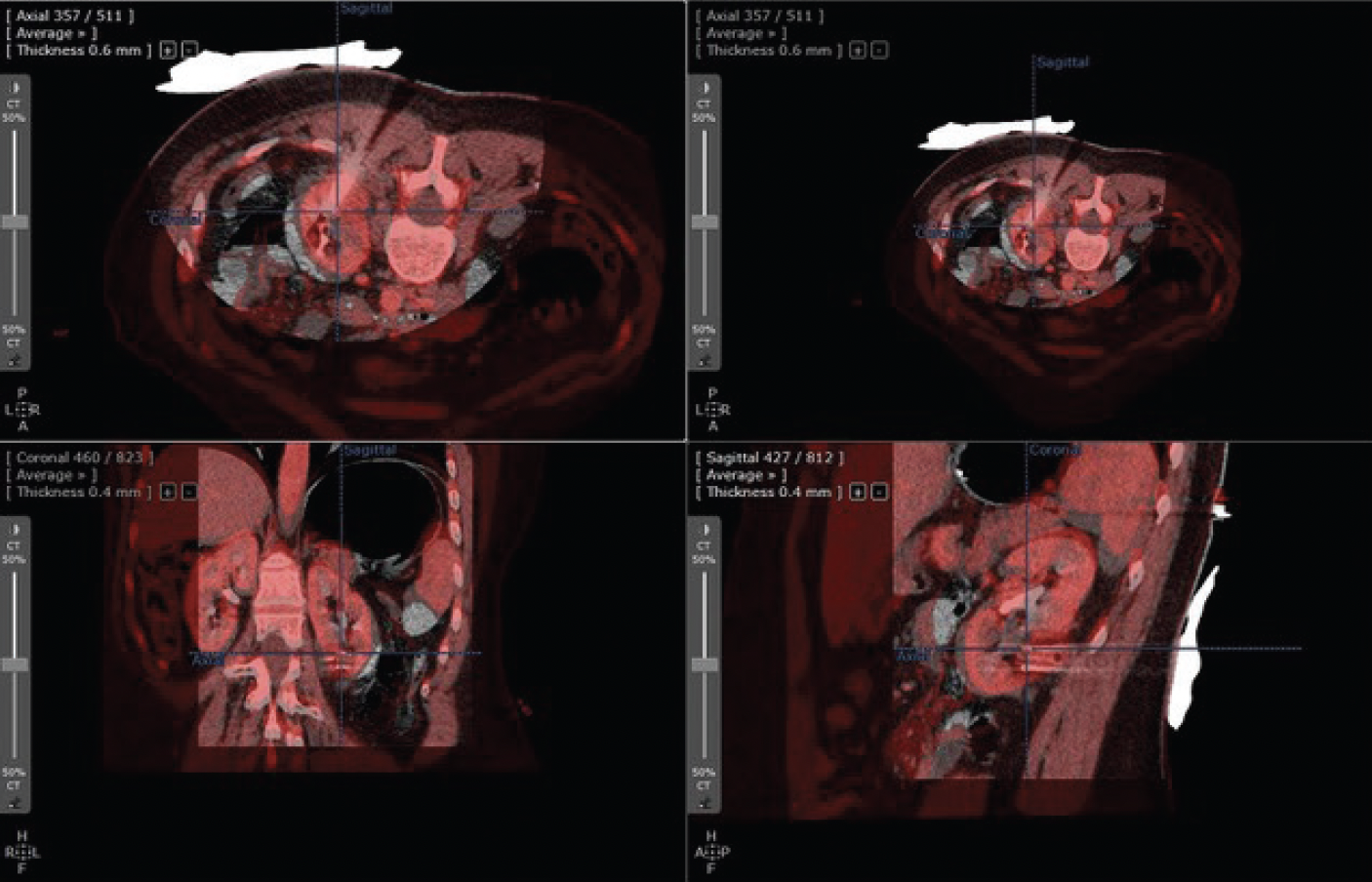 Renal Ablation: Can We Push the Treatment Boundaries? - Endovascular Today