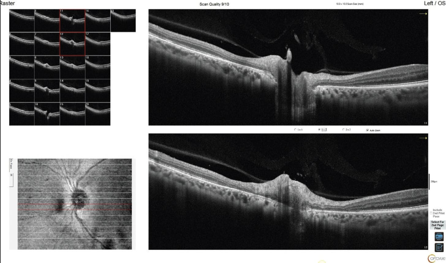 A Case of MEWDS - Modern Optometry
