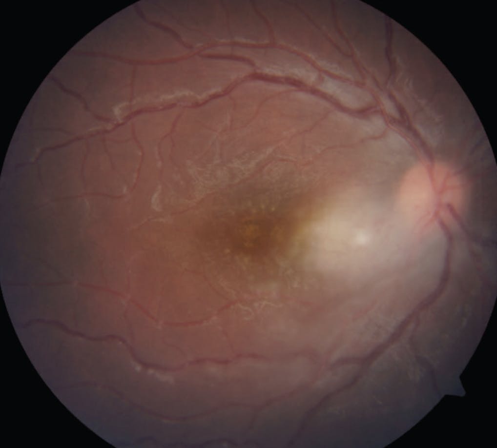 Intermediate Uveitis Snowbanking