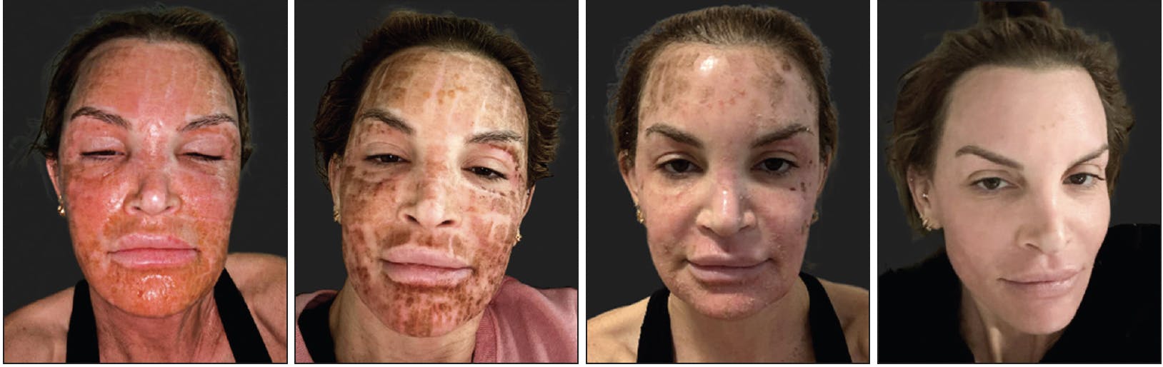 Healing Post-CO2 Laser Using MTP Technology - Modern Aesthetics