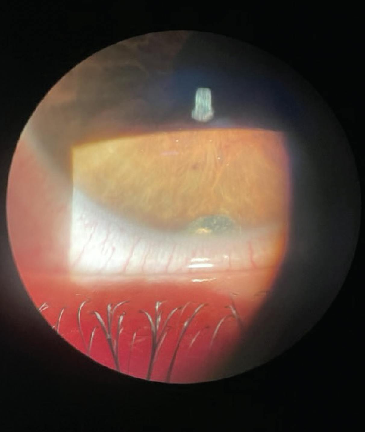 Traumatic Mydriasis Iris Repair Techniques