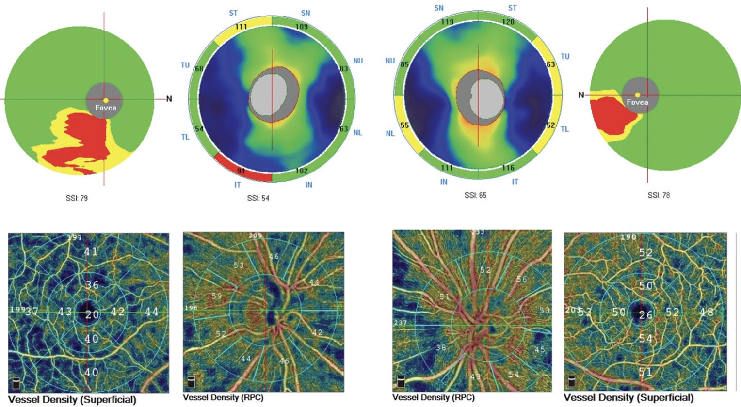Practical Insights on OCTA in Glaucoma - Modern Optometry