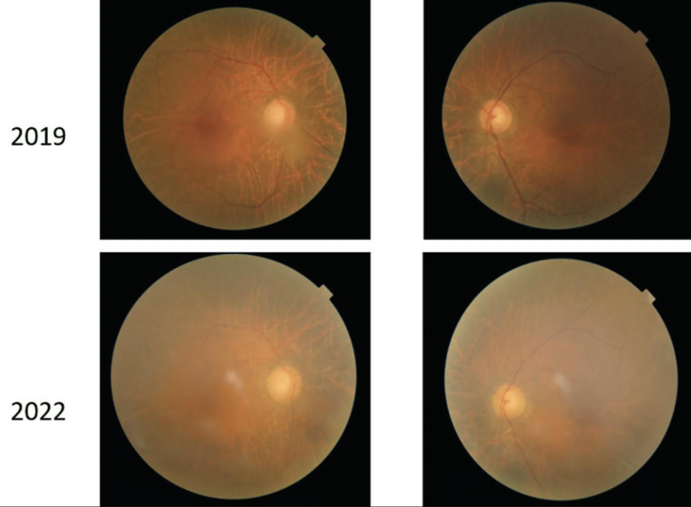 Spiculated Speculation: When RP and Glaucoma Collide - Modern Optometry