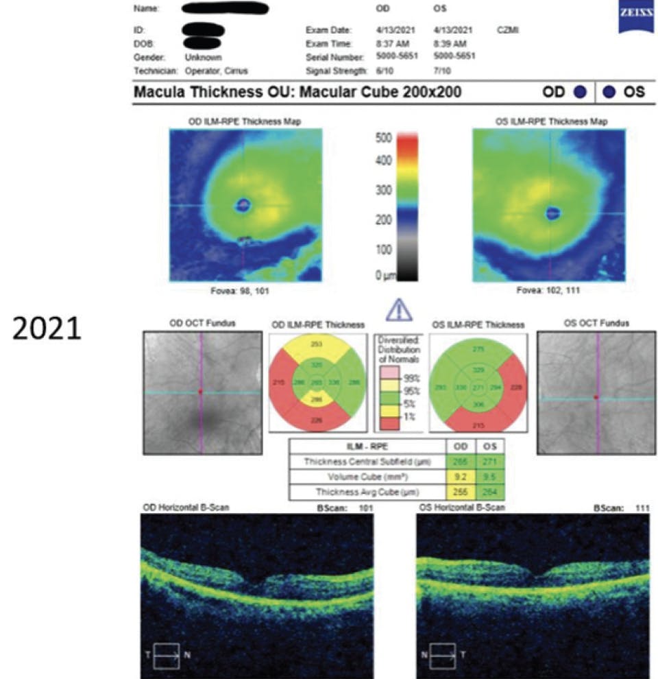Spiculated Speculation: When RP and Glaucoma Collide - Modern Optometry