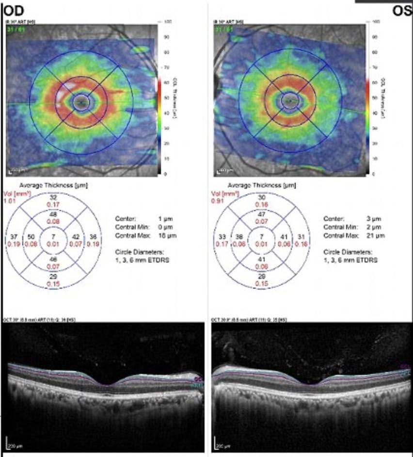 Ocular Effects of Pituitary Tumor - Modern Optometry