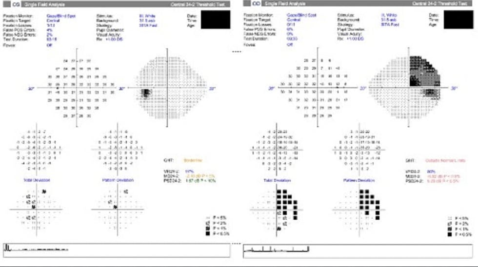 Ocular Effects of Pituitary Tumor - Modern Optometry