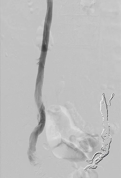 Addressing Pelvic Venous Disease With a New Class of Coils ...
