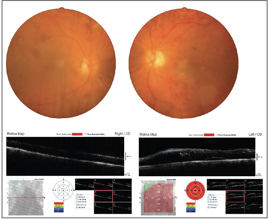 A Guideline for Managing Patients With DR - Modern Optometry