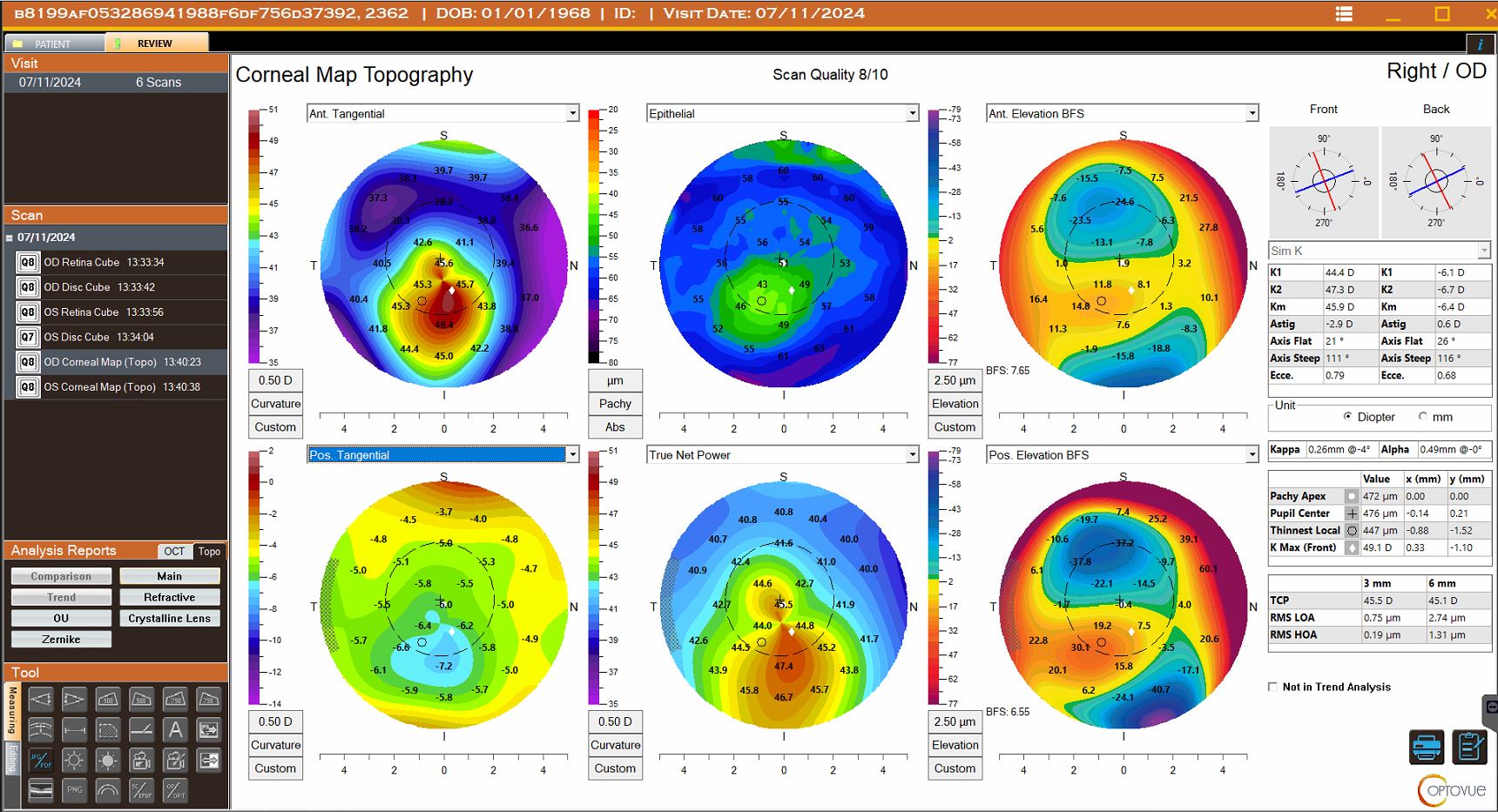 Visionix USA Introduces Topography Module for Optovue Solix OCT Systems ...