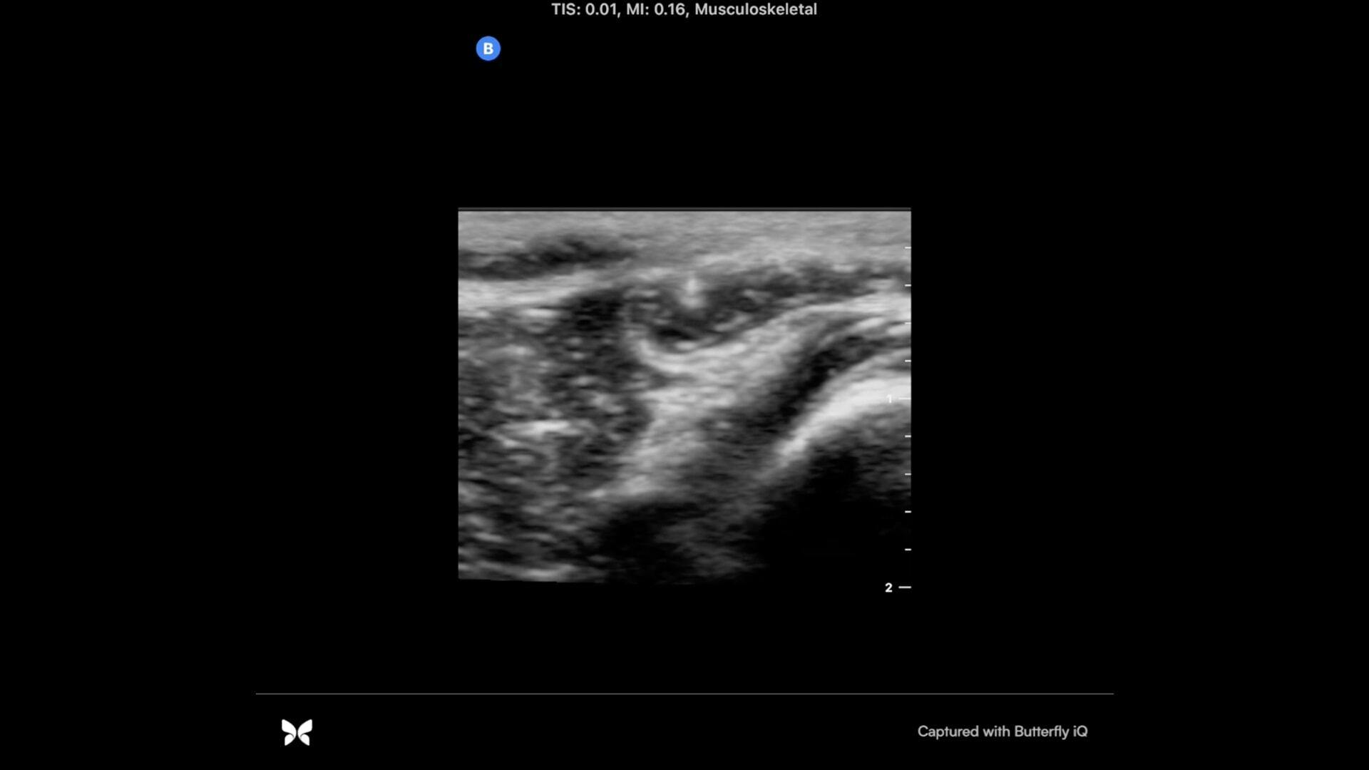 Botulin Toxin Injection - Practical Neurology