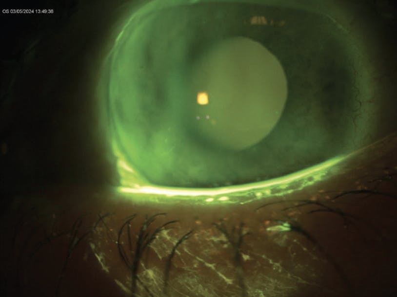 Neurotrophic Keratitis Post-Retinal Detachment Surgery - Modern Optometry