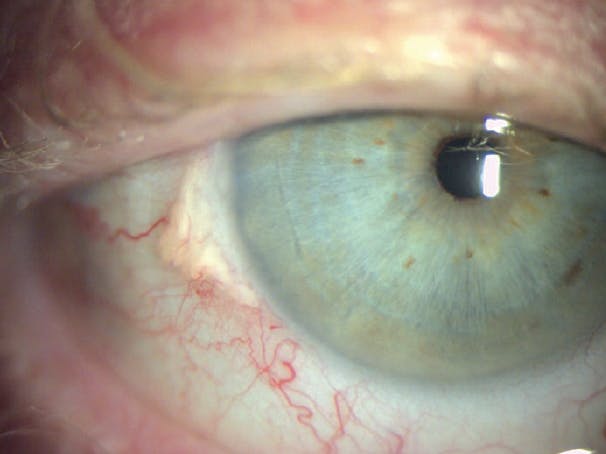 Chemotherapeutics in Eye Care: Ocular Surface Squamous Neoplasia ...