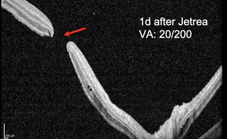 VMT and Retinal Detachment - Eyetube