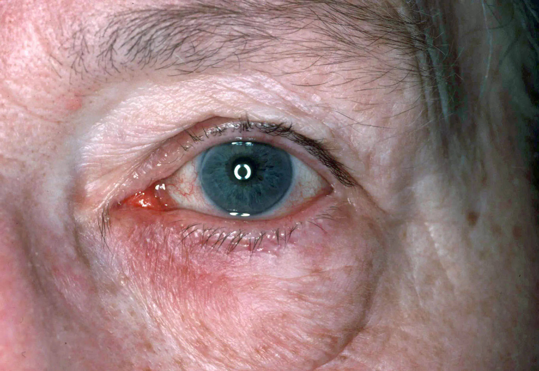 Researchers Define Keys to Recognizing Ocular Rosacea - Eyewire+