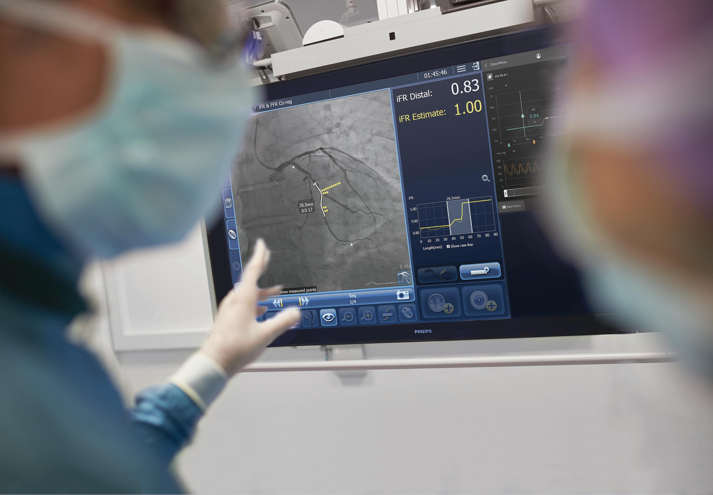Philips’ iFR Compared With FFR in Analysis of Real-World, Long-Term ...