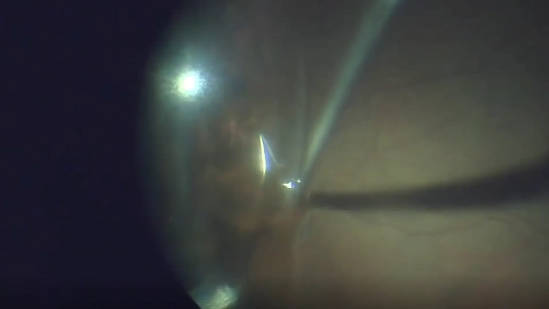 Giant Retinal Tear Detachment - Eyetube