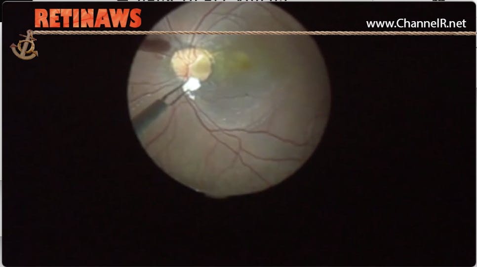 Optic Nerve Pit - Eyetube