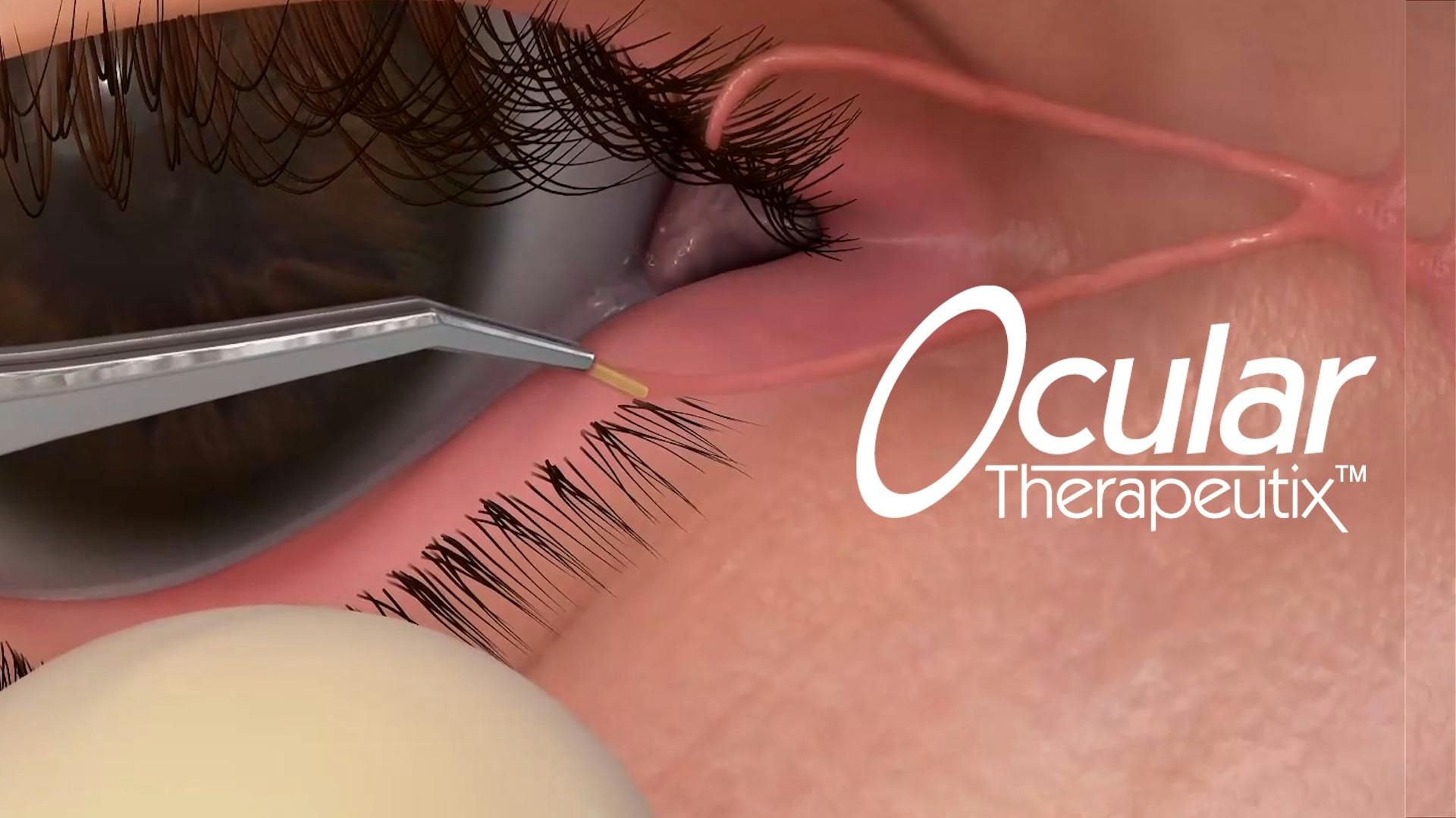 FDA Approves Dextenza for Treatment of Ocular Itching Associated with ...