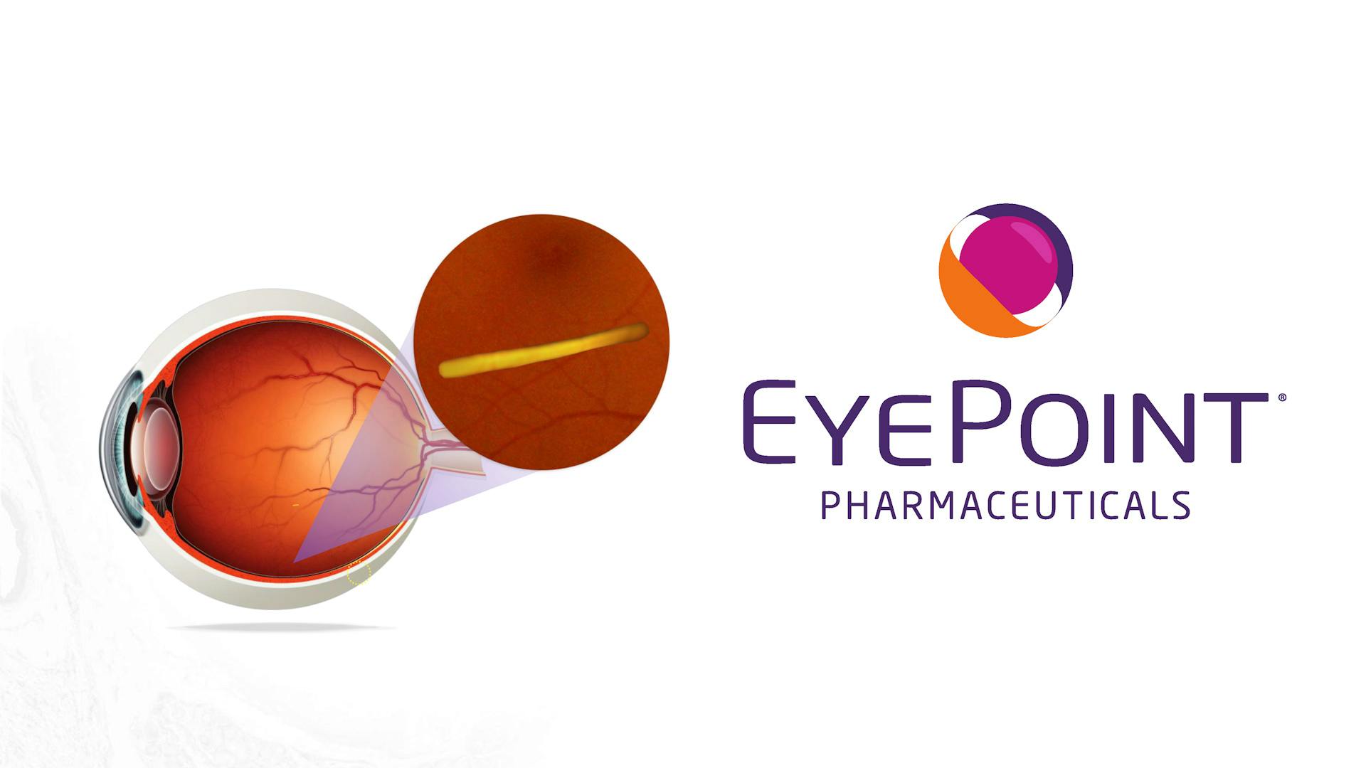 EyePoint’s Sustained-Release Wet AMD Therapy Meets All Endpoints in ...