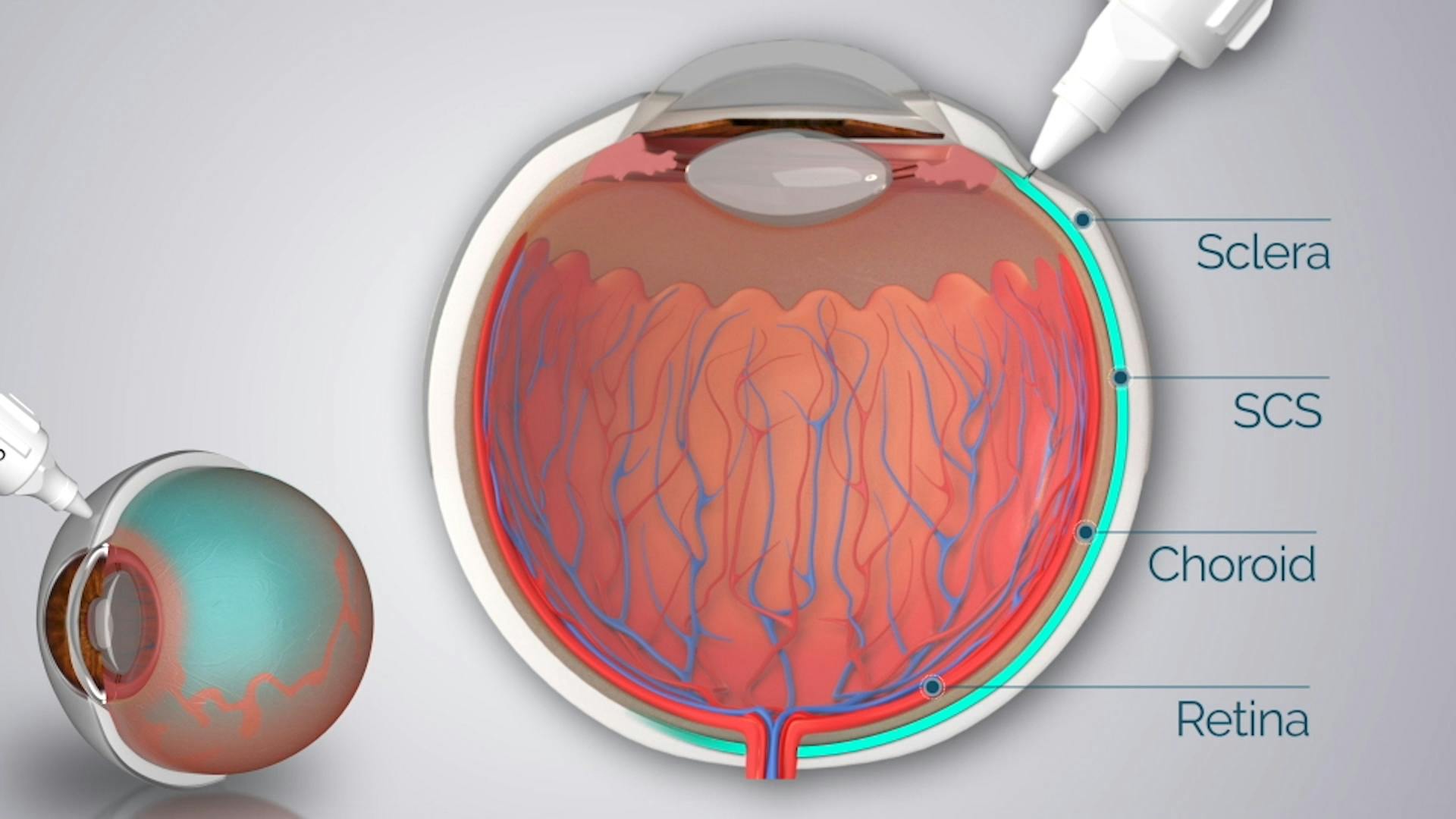 FDA Approves Xipere for Treatment of Macular Edema Associated with ...