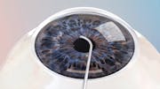 Glaukos Receives FDA Approval for iDose TR Intracameral Implant - Eyewire+