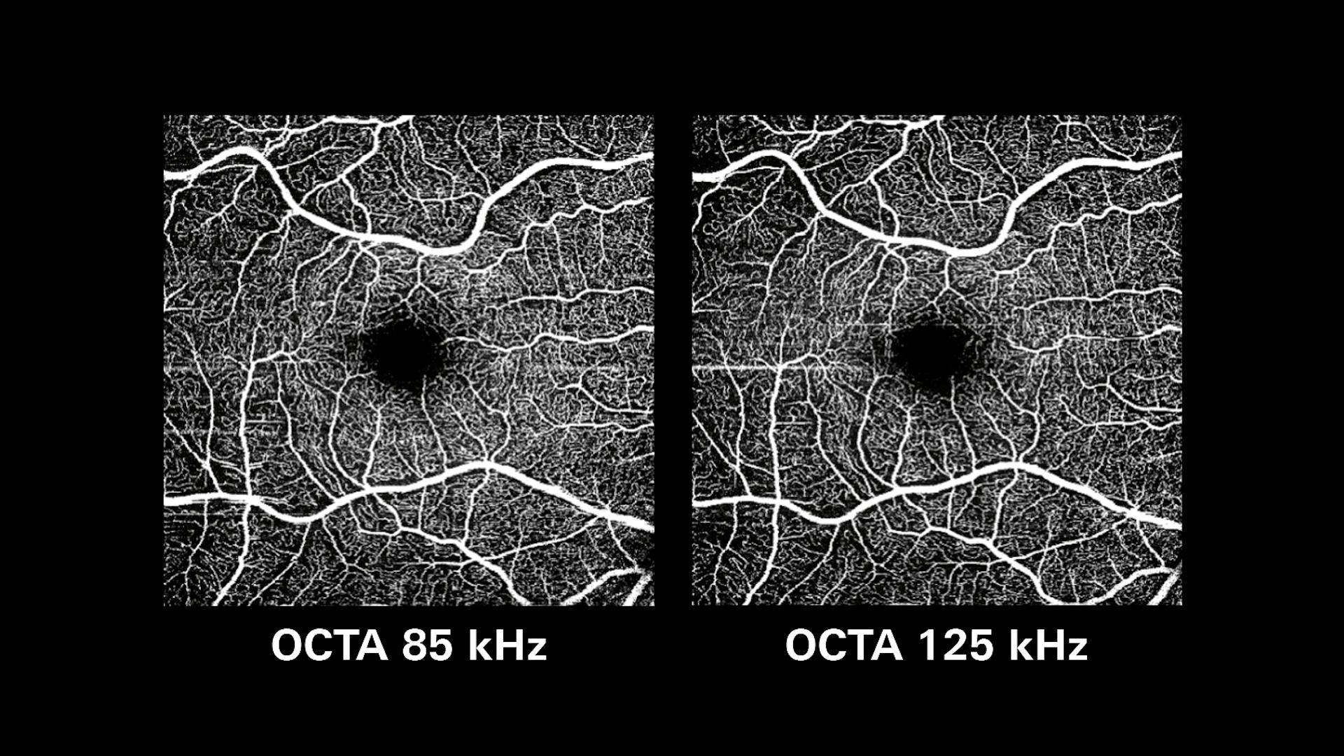 FDA Clears Heidelberg's Spectralis OCTA Module with Shift Technology ...