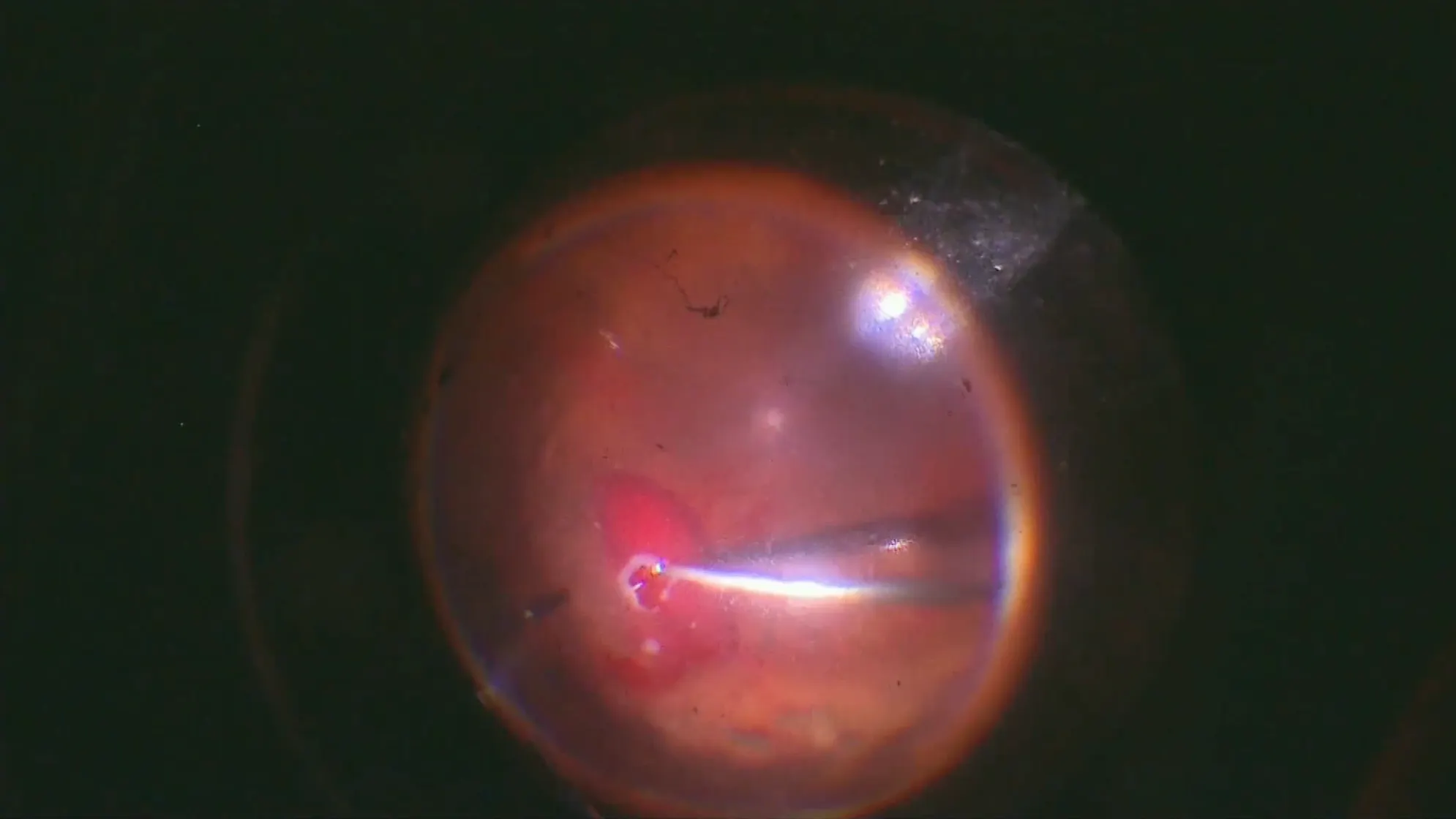 Vitreous Shaving - Eyetube