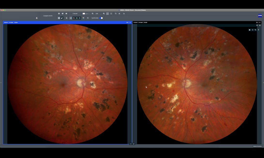 Simplifying Diabetic Retinopathy Follow-Up Over the Years with ZEISS ...