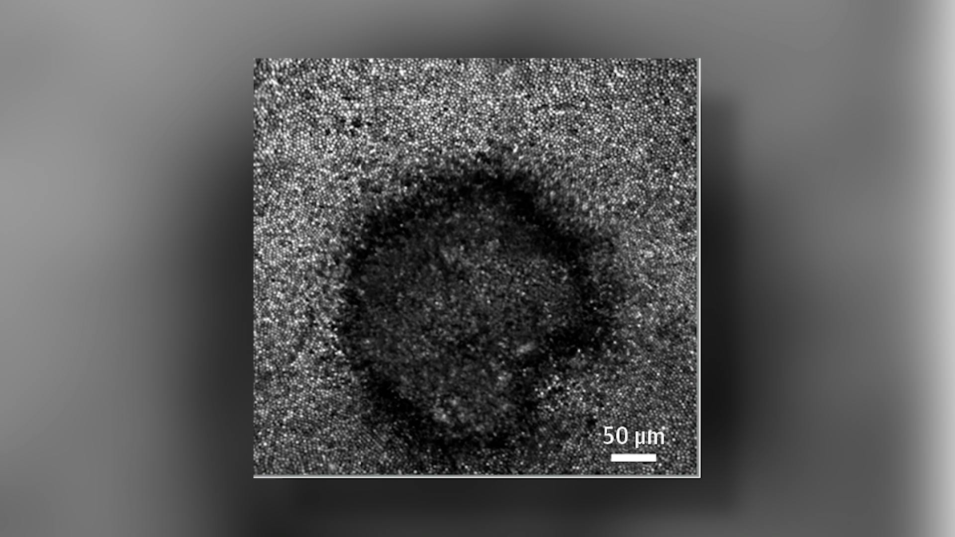 Solar Retinopathy Cases - Eyewire+