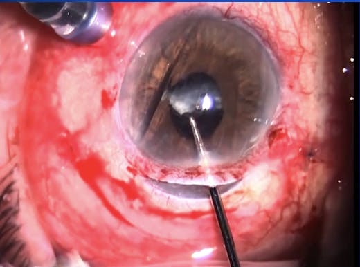 P. Acne Endophthalmitis - Eyetube