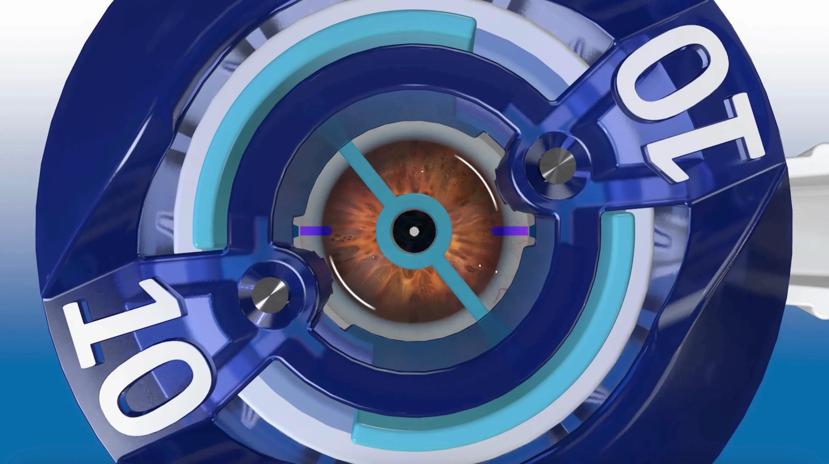 ArcDUO: Guided, Paired, Limited Depth Incisions - Eyetube