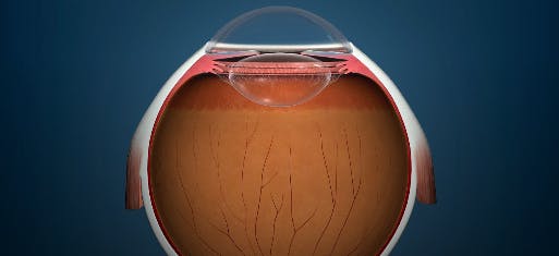 Iridex PSLT™ (Pattern Scanning Laser Trabeculoplasty) treatment for IOP Reduction - Eyetube