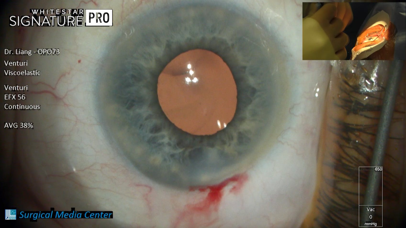 A Step by Step Phacoemulsification Procedure with Dr. Eva Liang - Eyetube