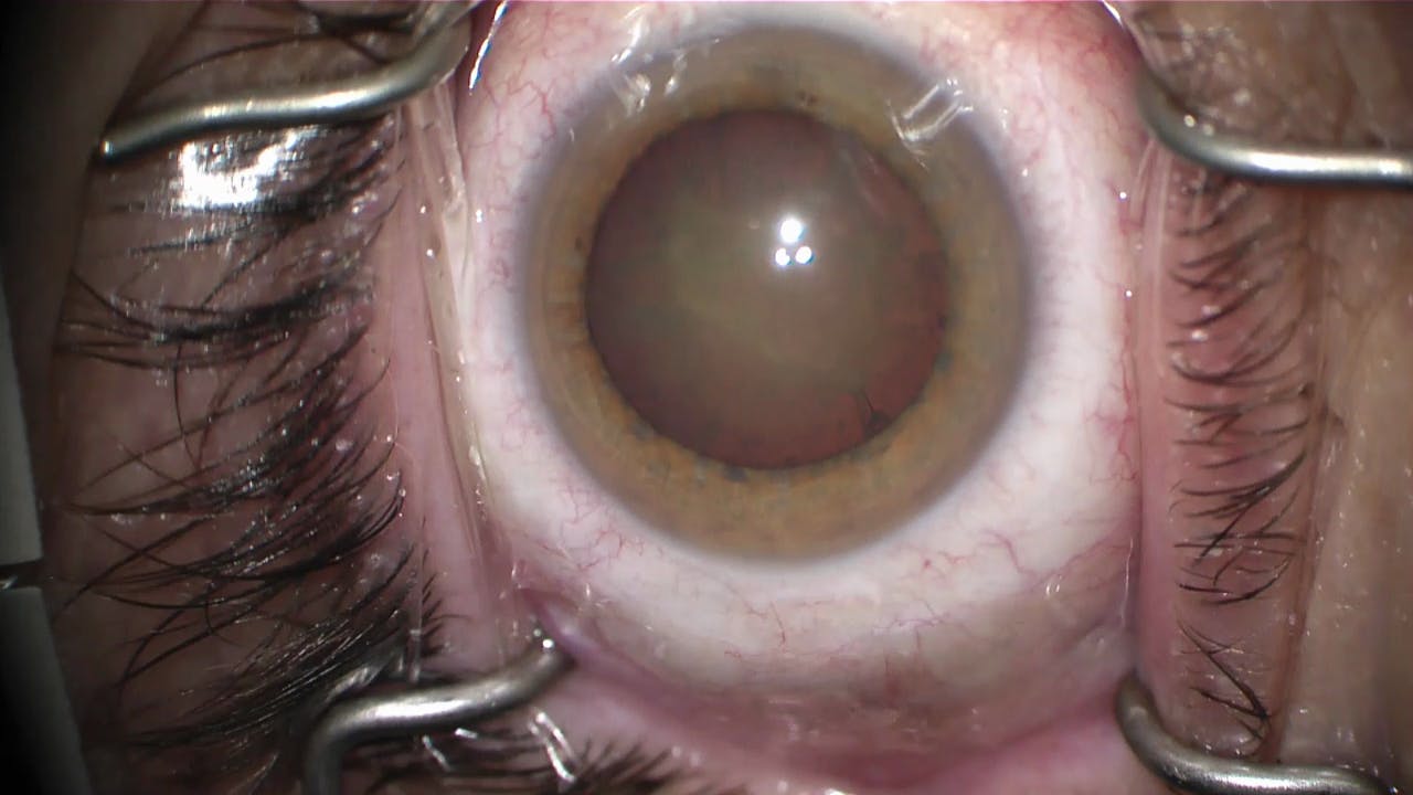 Post-Vitrectomy Acute Cataract - Eyetube